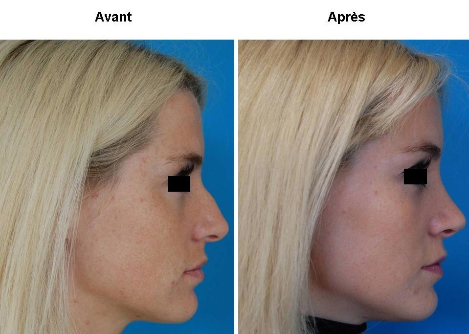 Chirurgie du nez Lyon : Dr Bayol, intervention chirurgicale ... Chirurgie du nez Lyon : Dr Bayol, intervention chirurgicale ...