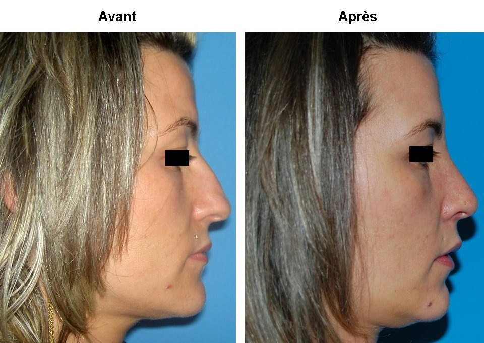 Chirurgie du nez Lyon : Dr Bayol, intervention chirurgicale ... Chirurgie du nez Lyon : Dr Bayol, intervention chirurgicale ...